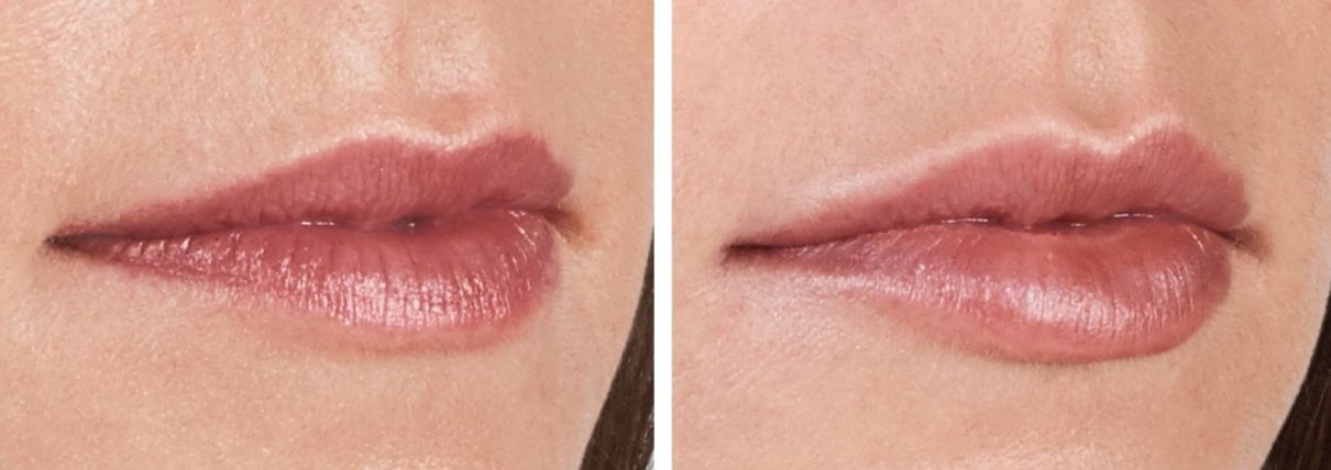 Botox + Filler | Signature Dermatology